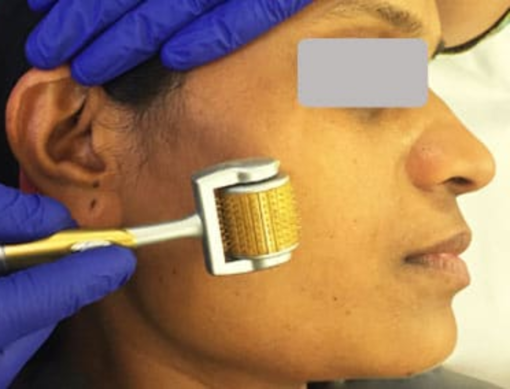 Acne Scar Surgery – drsharvariPandit