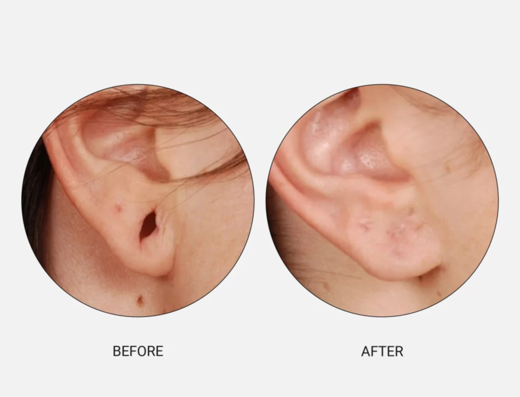 Ear Lobe Repair – drsharvariPandit